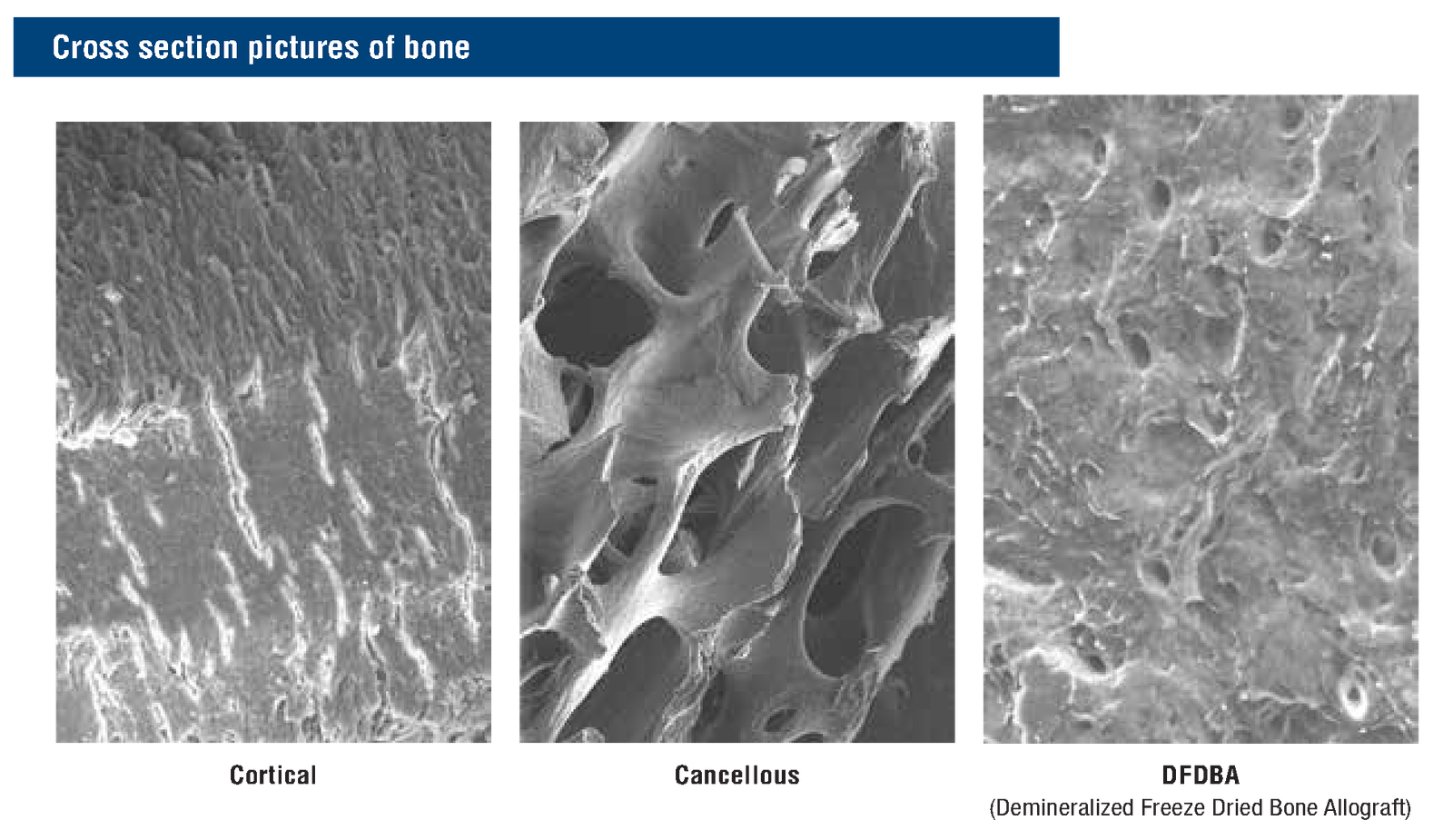 Hans Biomed - Autogenous Bone Grafting | Hiossen® Implant