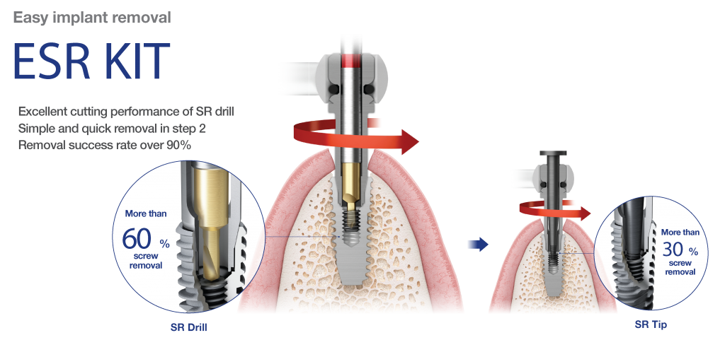 Easy Screw Removal (ESR) KIT | Hiossen® Implant