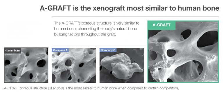 Dental Bone Graft Material Options: A-Graft | Hiossen® Implant
