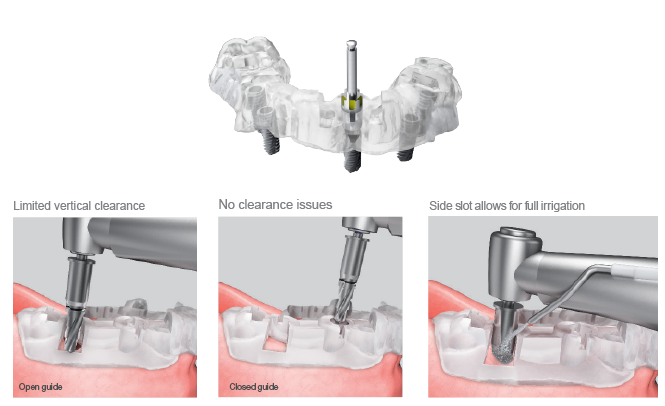 Smart Fit Abutment | Hiossen® Implant